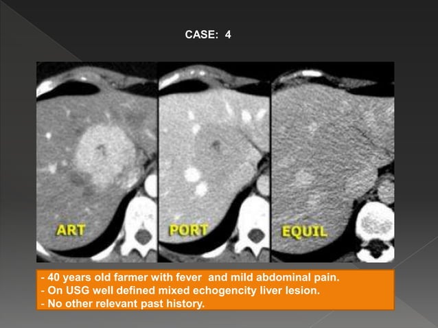 Liver imaging ct scan algorithm | PPTX | Lung and Respiratory Health ...