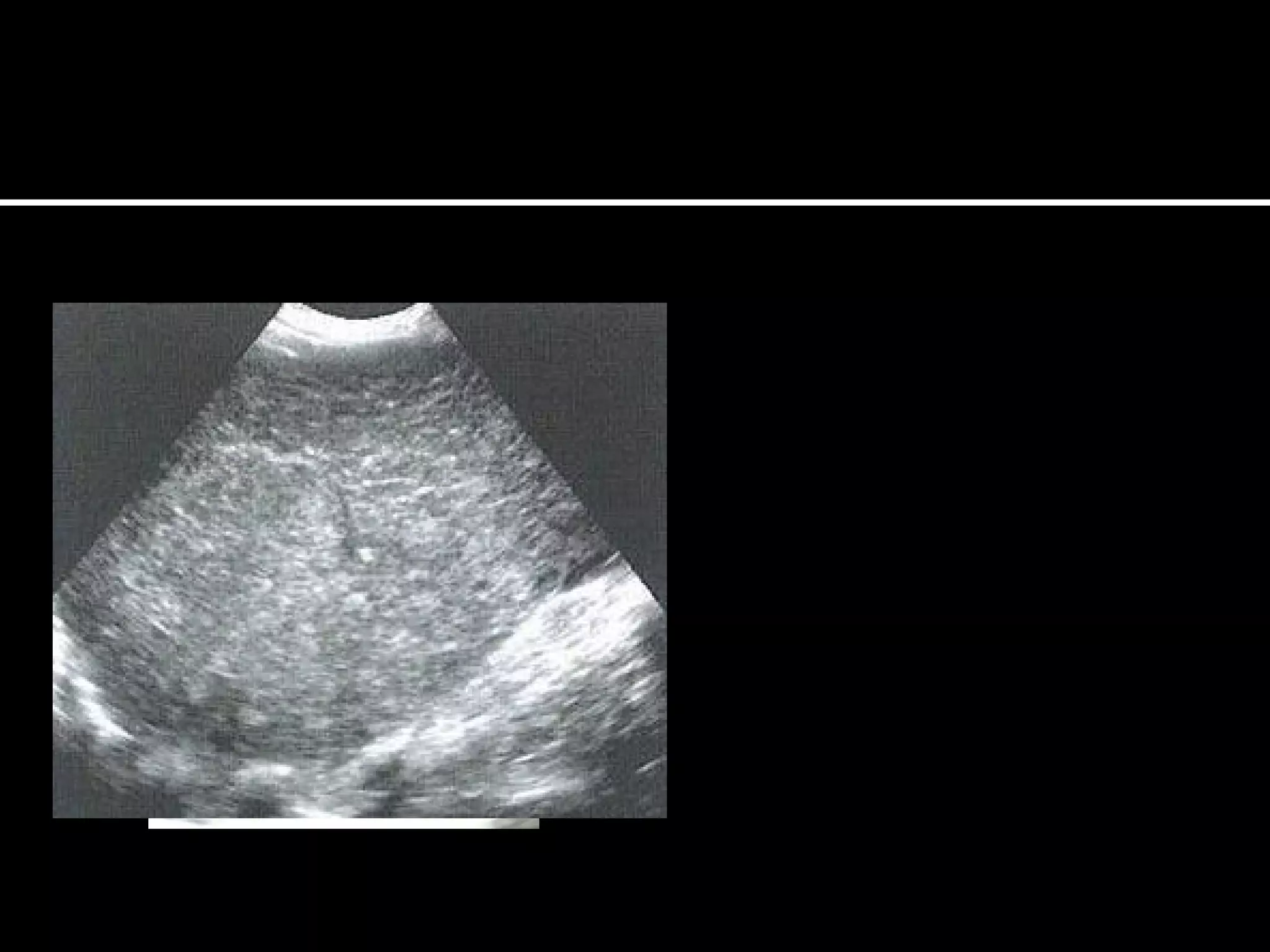 Liver imaging snapshots role of CT USG MRI in liver imaging. | PPT