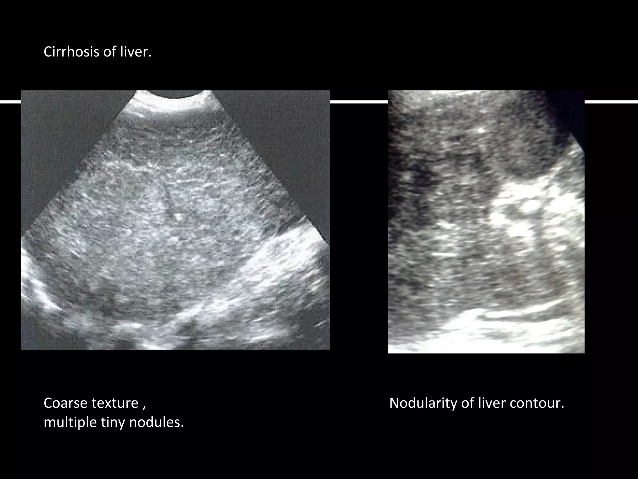 Liver imaging snapshots role of CT USG MRI in liver imaging. | PPT
