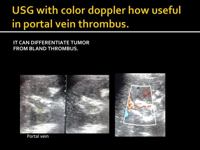 Liver imaging snapshots role of CT USG MRI in liver imaging. | PPT