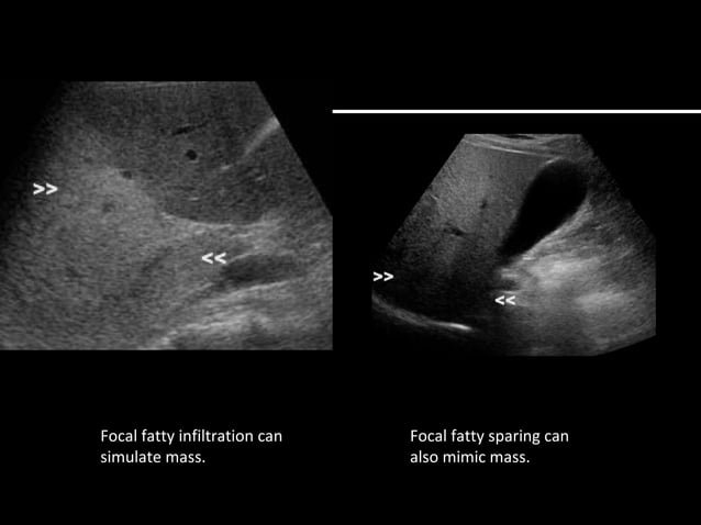Liver imaging snapshots role of CT USG MRI in liver imaging. | PPT