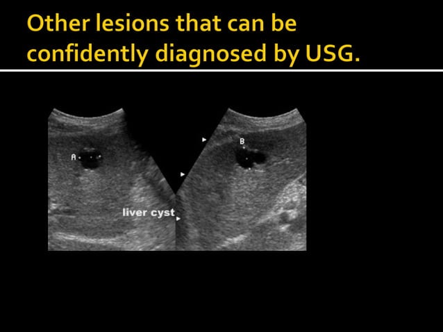 Liver imaging snapshots role of CT USG MRI in liver imaging. | PPT