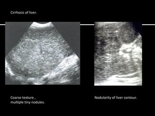 Liver imaging snapshots role of CT USG MRI in liver imaging. | PPT