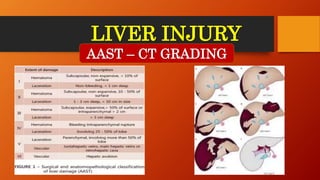 LIVER INJURY- TRAUMA SURGERY.pptx