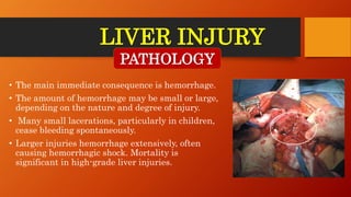 LIVER INJURY- TRAUMA SURGERY.pptx