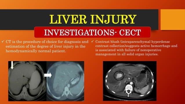 LIVER INJURY- TRAUMA SURGERY.pptx