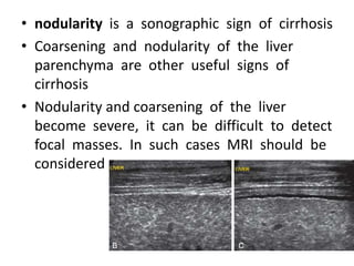 Liver lesion by dr muhammad qasim khan | PPTX | Medical Health