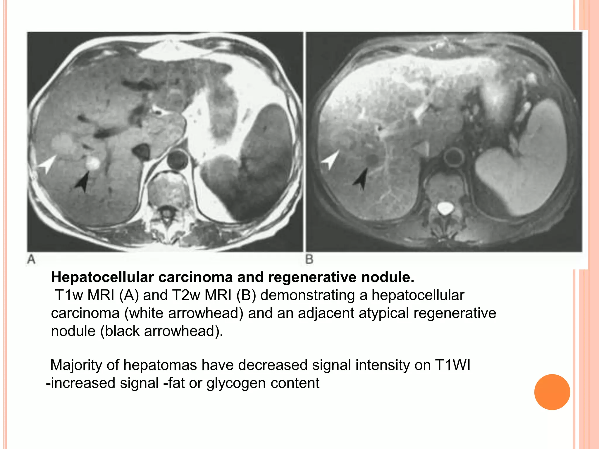 Liver lesions SYMPOSIUM RADIOLOGY | PPTX