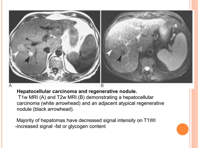 Liver lesions SYMPOSIUM RADIOLOGY | PPTX