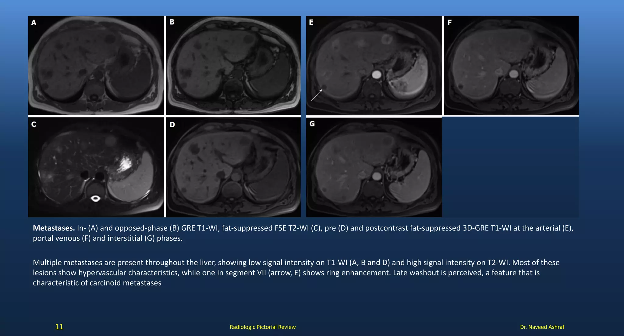 Liver lesions on mri | PDF