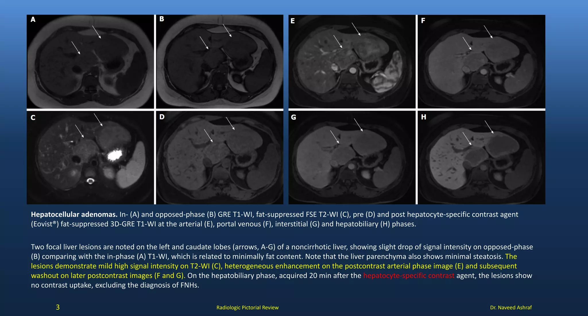 Liver lesions on mri | PDF