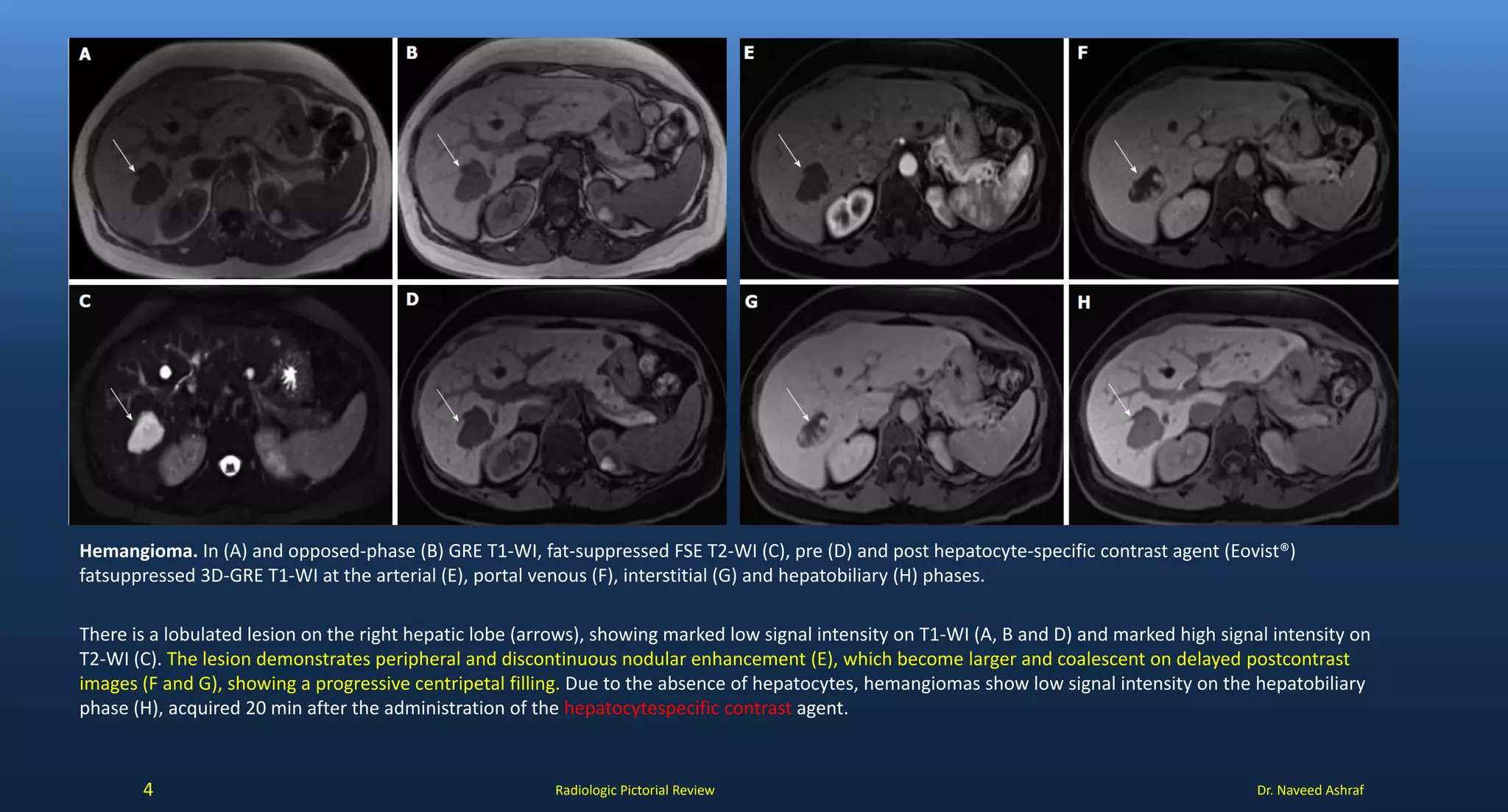 Liver lesions on mri | PDF