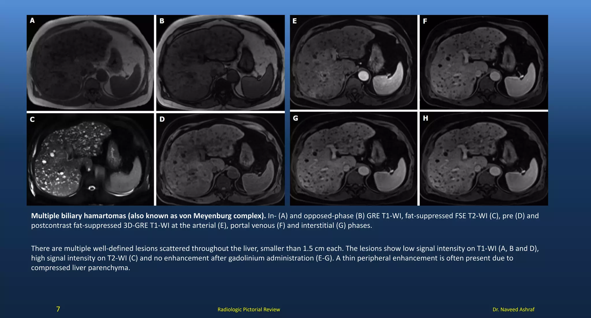 Liver lesions on mri | PDF