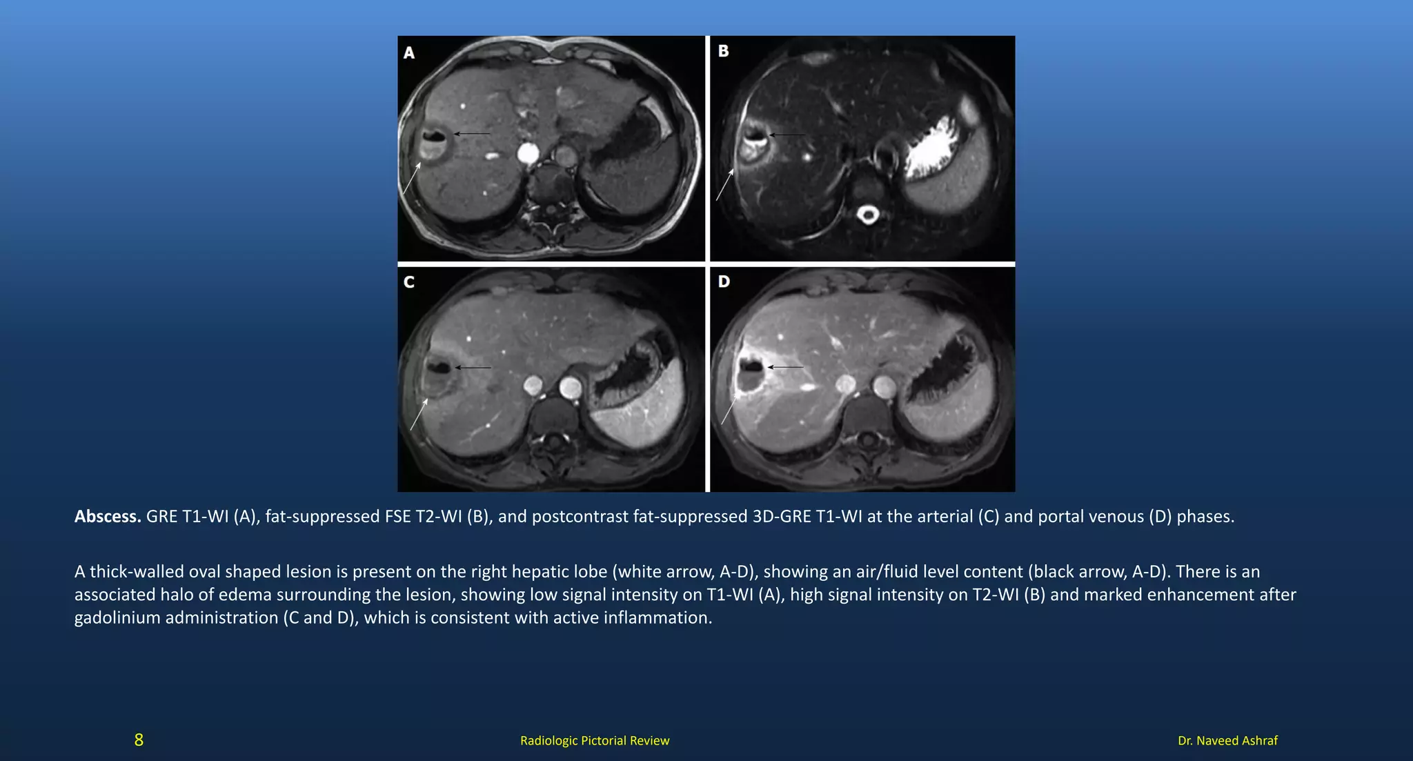 Liver lesions on mri | PDF