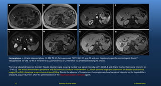 Liver lesions on mri | PDF