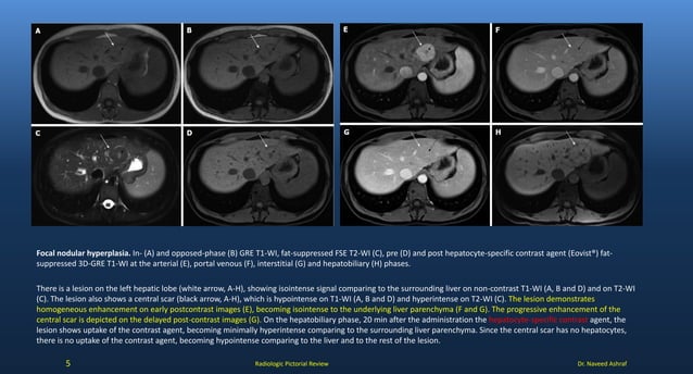 Liver lesions on mri | PDF