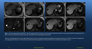Liver lesions on mri | PDF