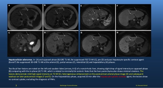 Liver lesions on mri