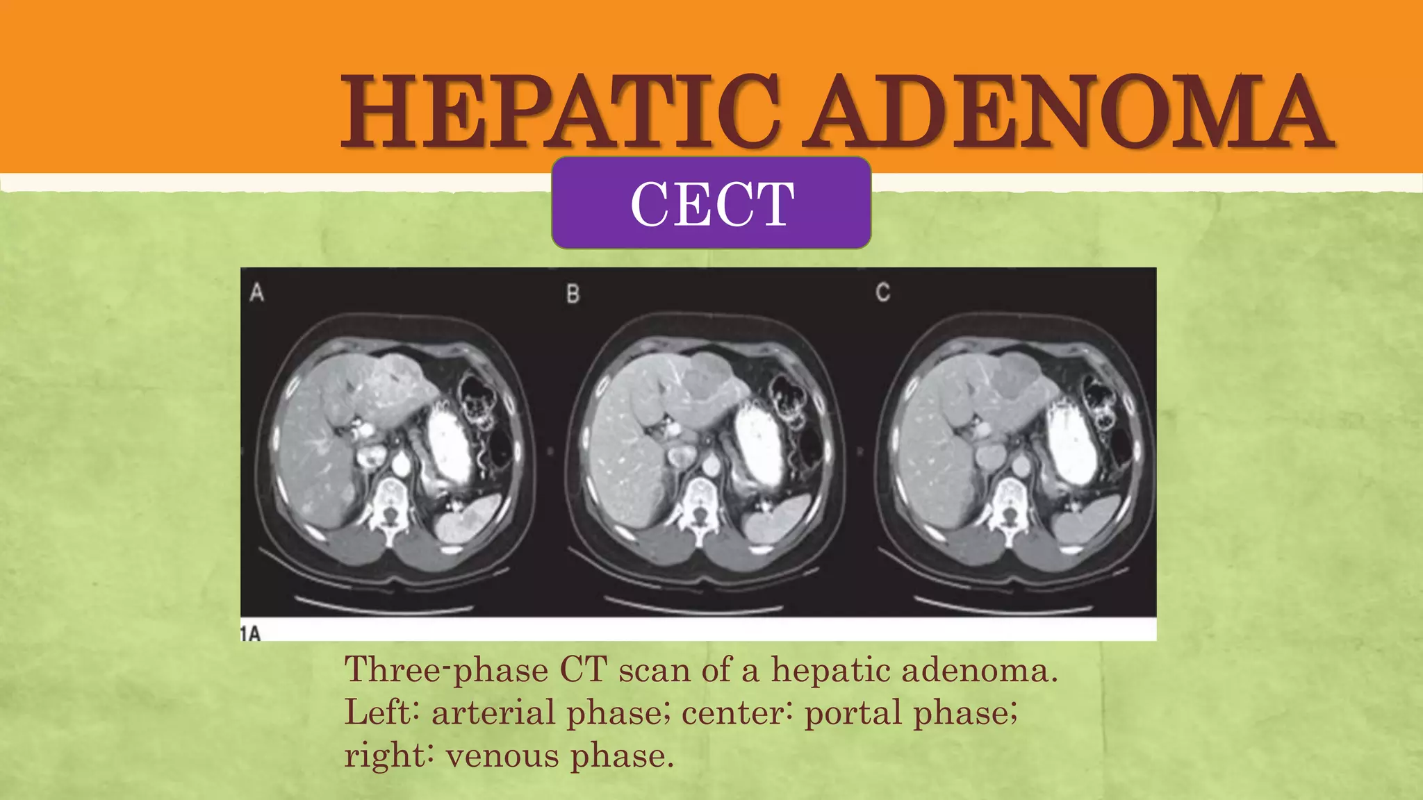 LIVER LUMPS- Rt Upper Quadrant Lumps- Abdominal Lumps.pptx