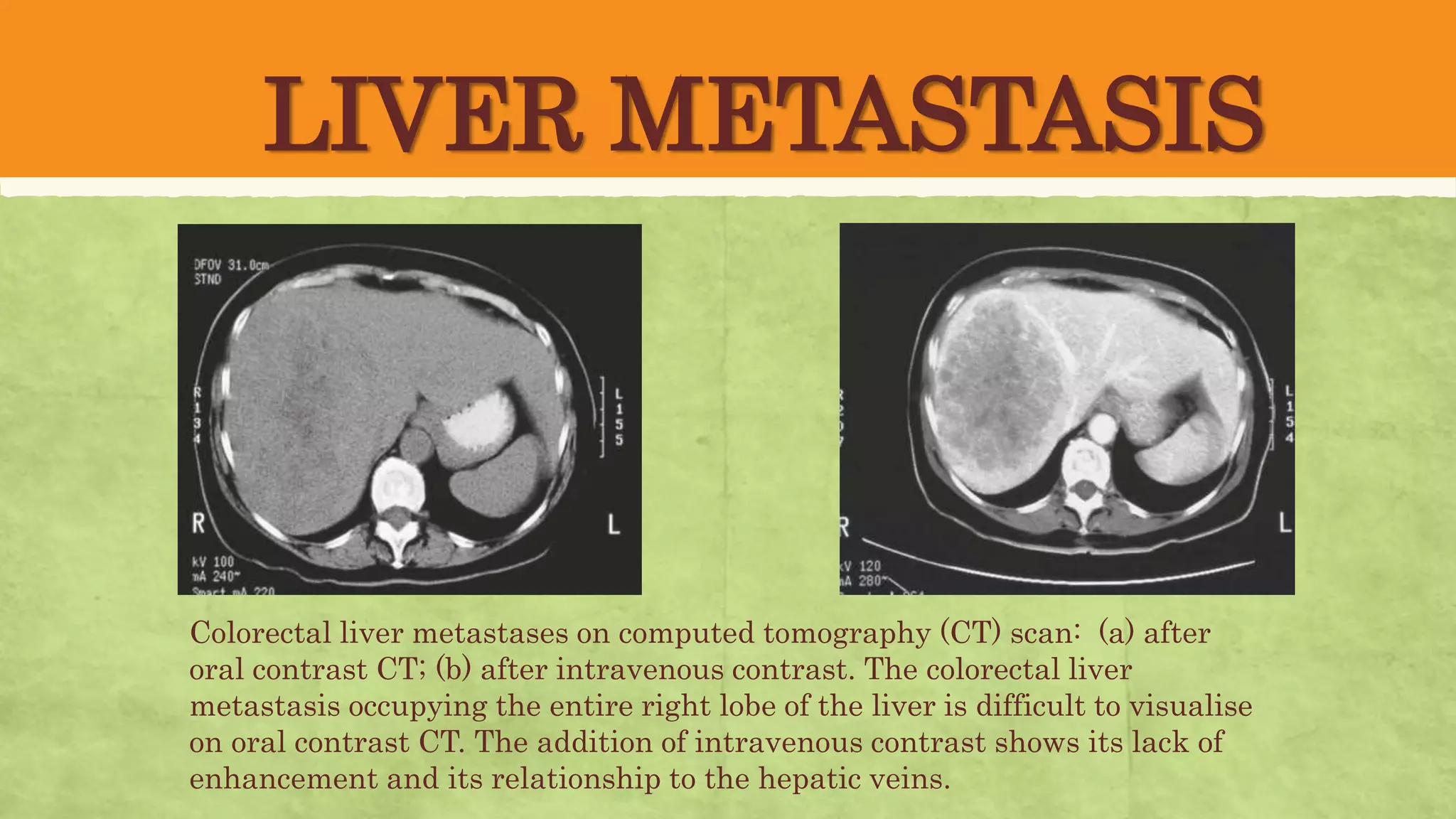 LIVER LUMPS- Rt Upper Quadrant Lumps- Abdominal Lumps.pptx