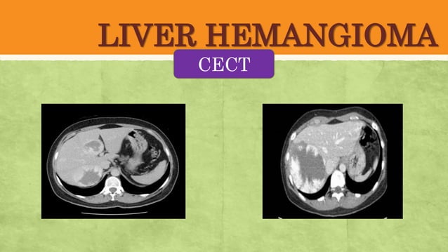 LIVER LUMPS- Rt Upper Quadrant Lumps- Abdominal Lumps.pptx