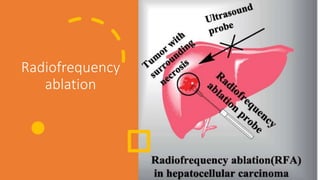 HCC MANGEMENT(RAD ONCO) | PPT