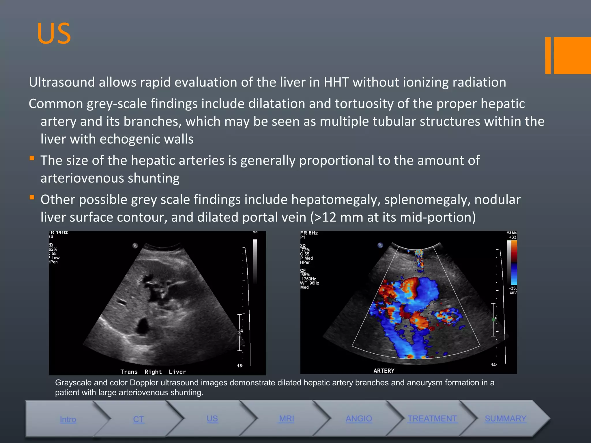 Liver manifestations of hht revised | PPT