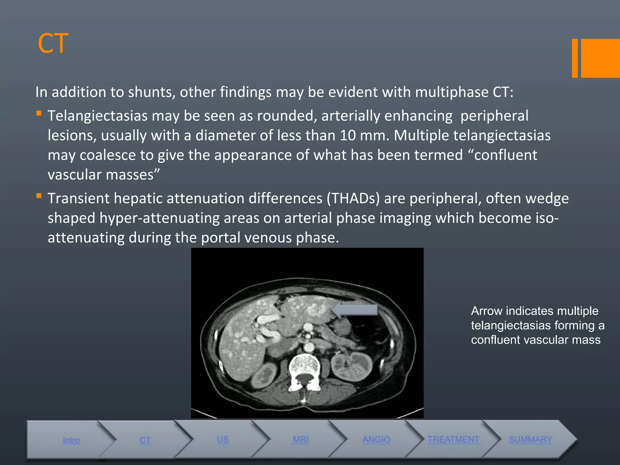 Liver manifestations of hht revised | PPT