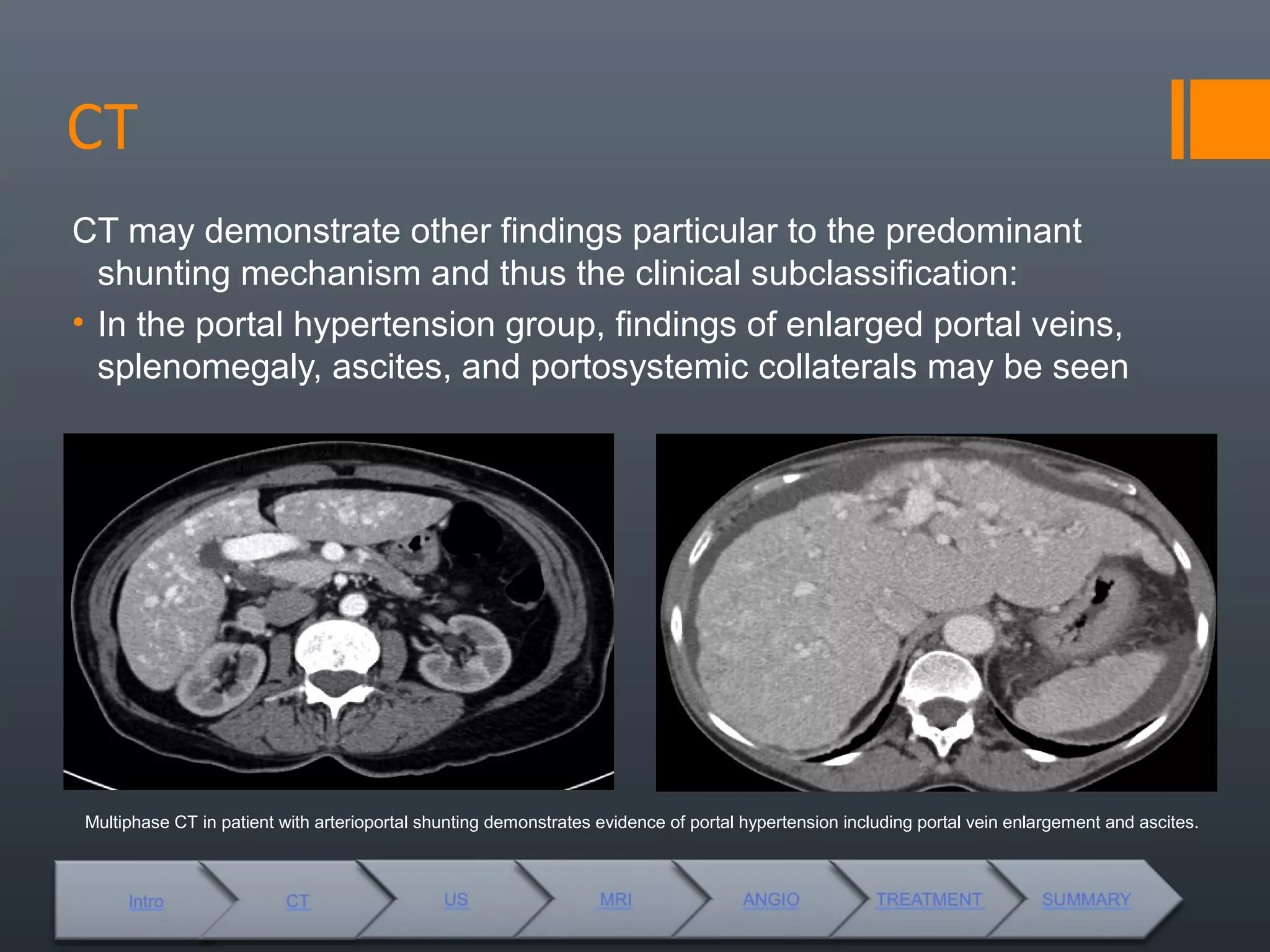 Liver manifestations of hht revised | PPT