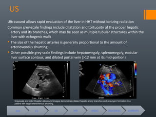 Liver manifestations of hht revised | PPT