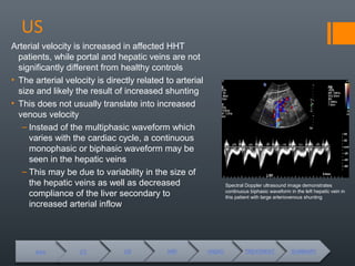 Liver manifestations of hht revised | PPT