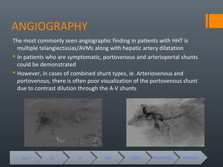 Liver manifestations of hht revised | PPT