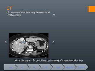 Liver manifestations of hht revised | PPT