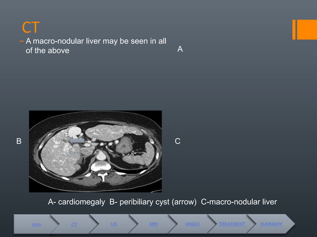 Liver manifestations of hht revised | PPT