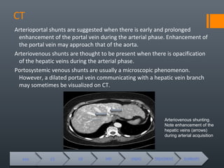 Liver manifestations of hht revised | PPT