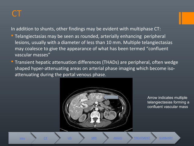 Liver manifestations of hht revised | PPT