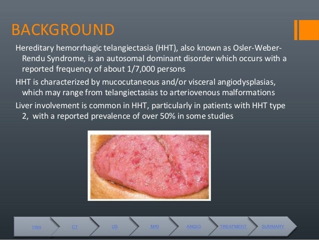 Liver manifestations of hht revised