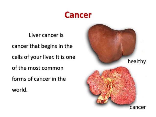 Liver Problems Ppt
