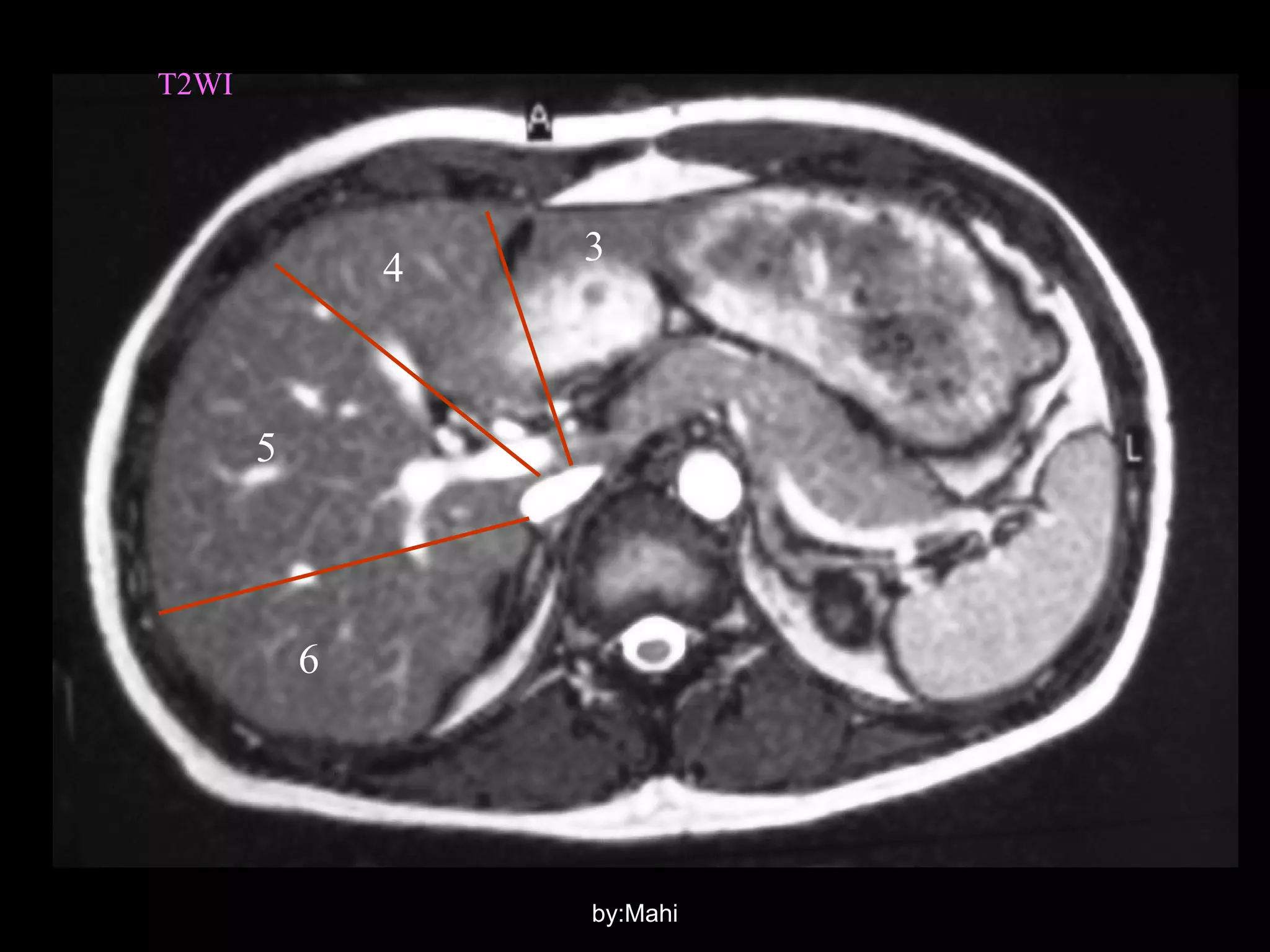 Liver radiology MRI | PPT