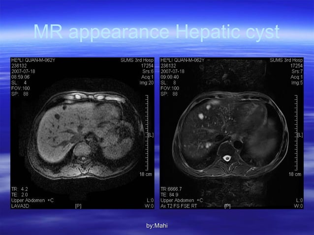 Liver radiology MRI | PPT