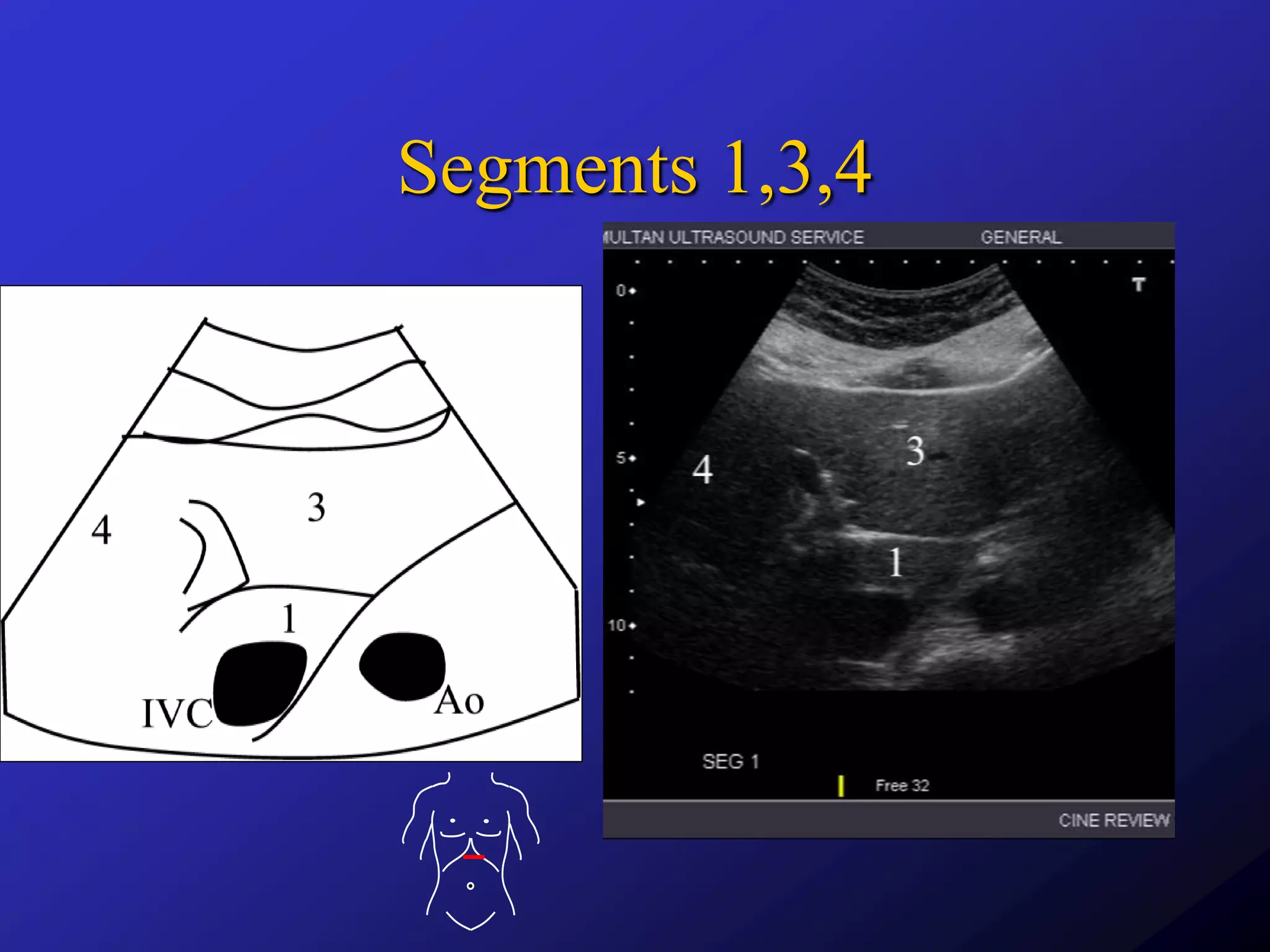 Liver segments on ultrasound | PPTX