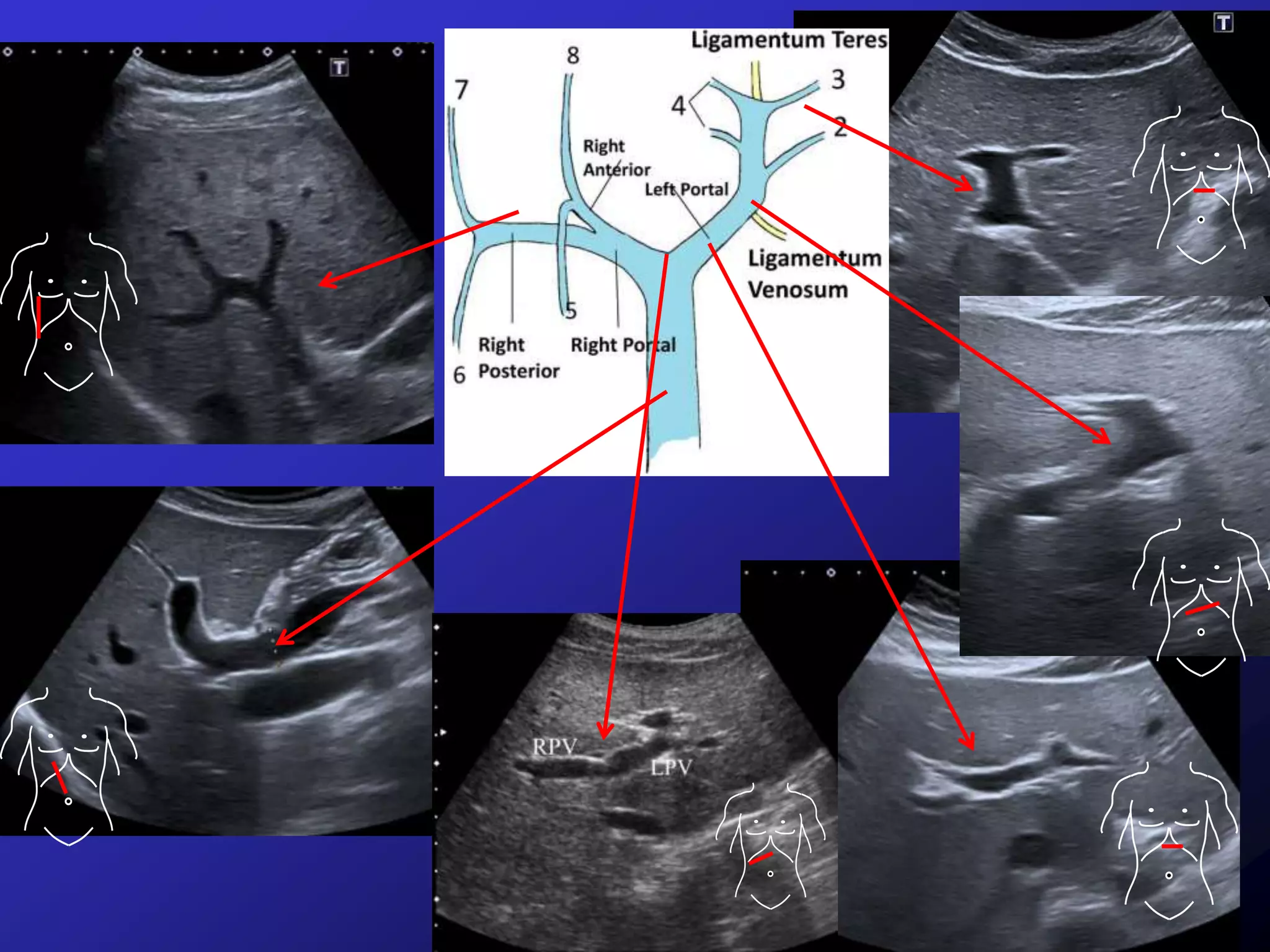 Liver segments on ultrasound | PPTX
