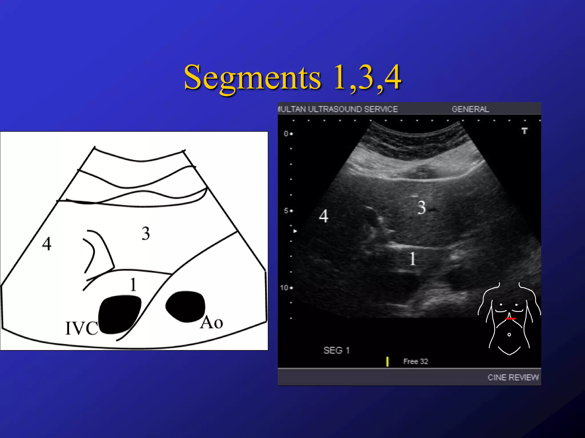 Liver Segments On Ultrasound Ppt