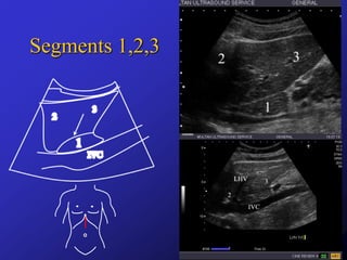 Liver segments on ultrasound | PPTX