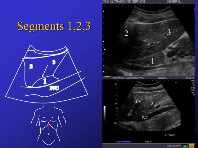 Liver segments on ultrasound | PPTX