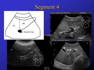 Liver segments on ultrasound | PPTX