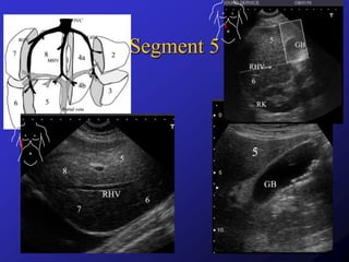 Liver segments on ultrasound | PPTX