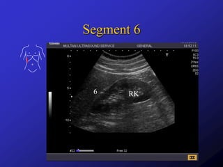 Liver segments on ultrasound | PPTX