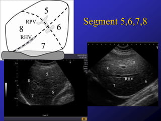 Liver segments on ultrasound | PPTX