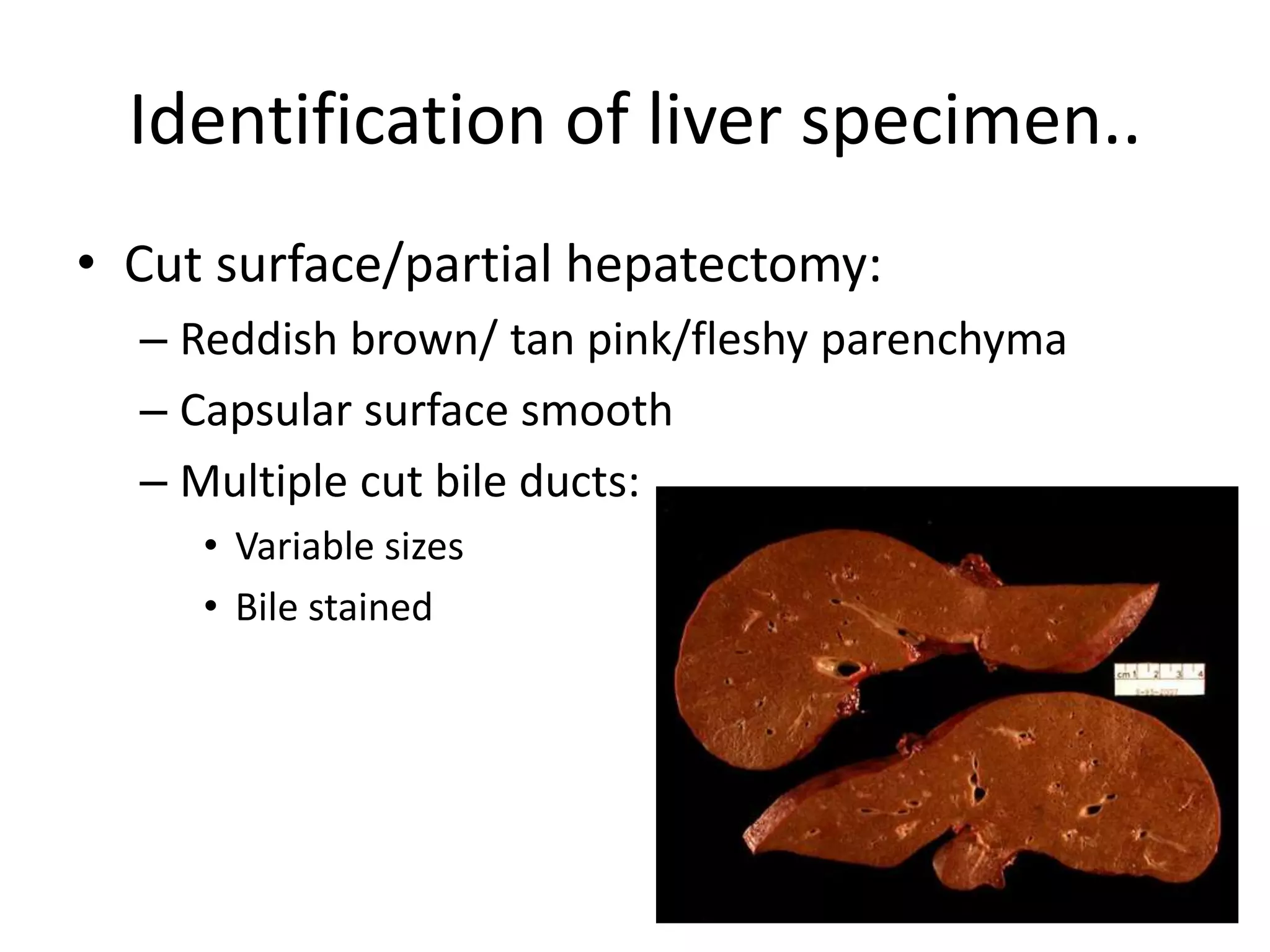 Liver specimen: Hepatocellular carcinoma, liver abscess | PPTX ...